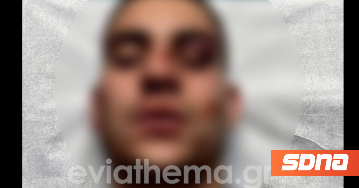 Χαλκίδα: 18χρονος έστειλε στο νοσοκομείο με κατάγματα 19χρονο για ένα like | SDNA